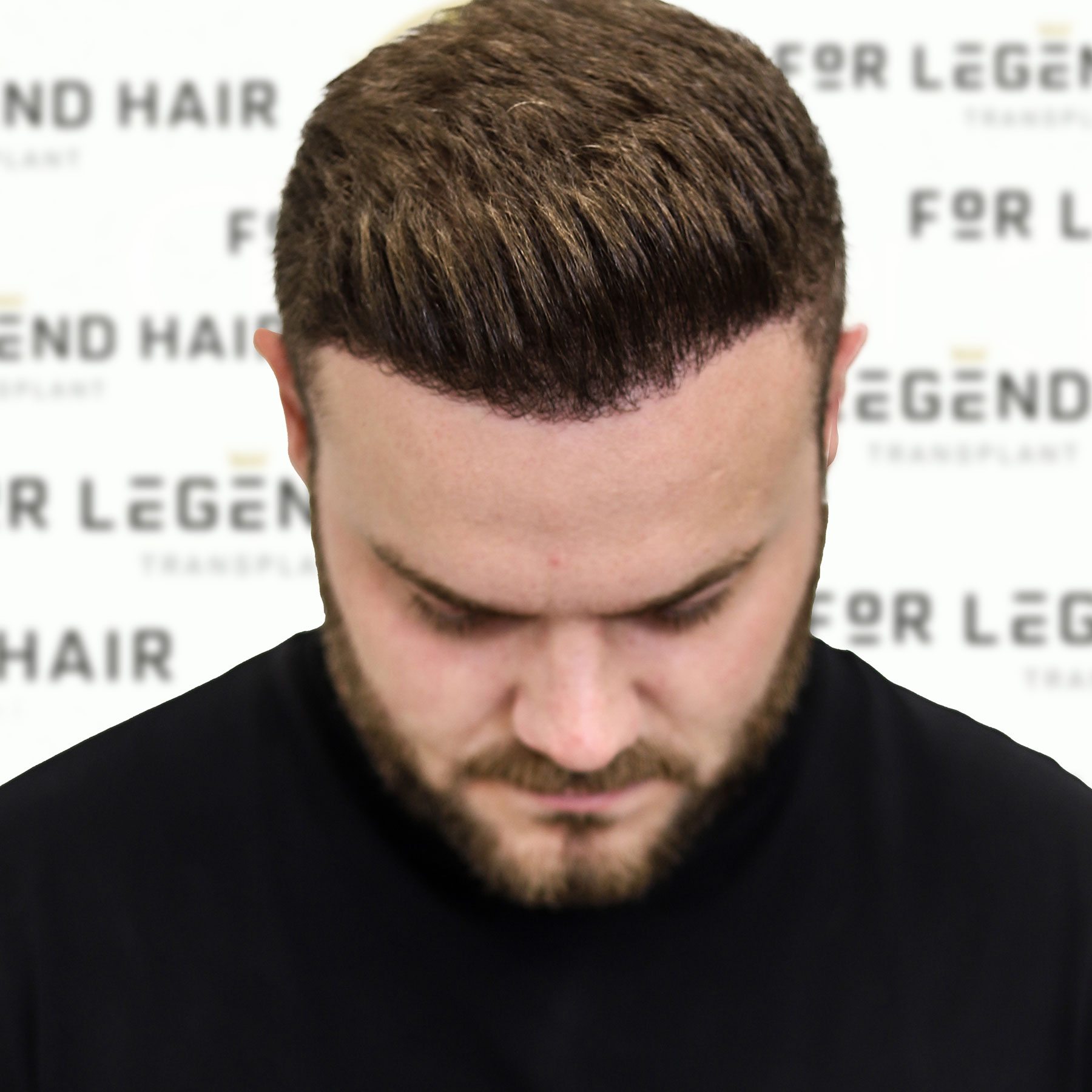 For Legend Hair – Hair Transplant in Turkey | Istanbul